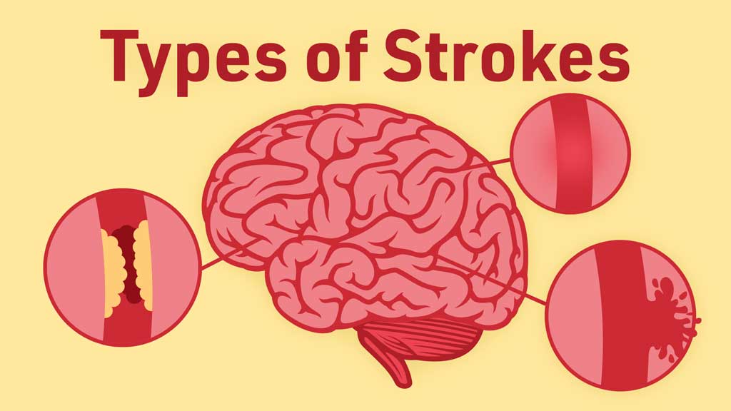Everything You Need to Know About Stroke | MedsBase