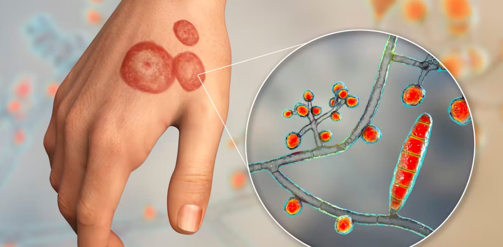 Understanding Fungal Infections | MedsBase