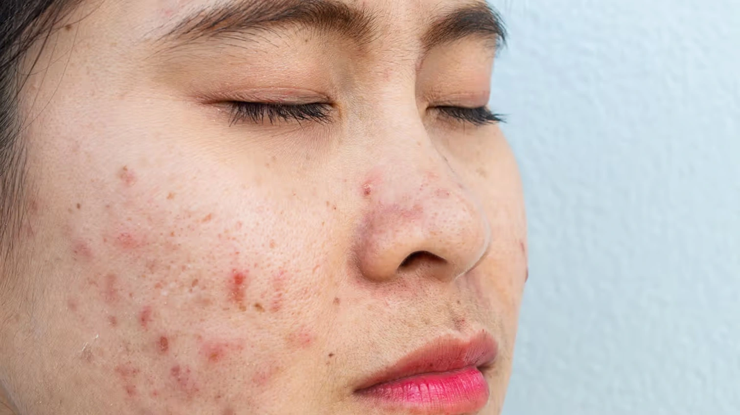 All About Common Skin Disorders | MedsBase