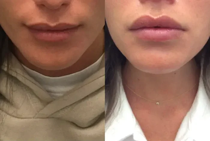 Lip Flip: Procedure, Cost, and Potential Complications