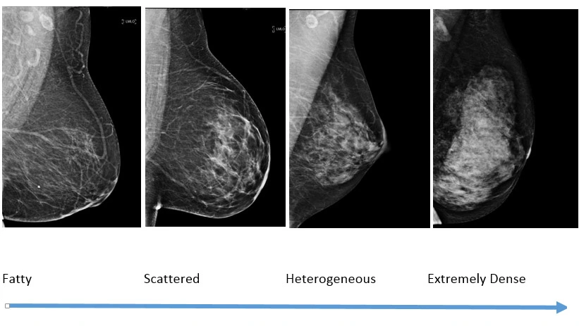 Breast Density After a Mammogram: What to Know | MedsBase